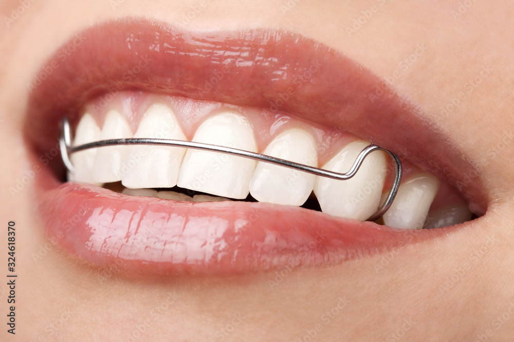 Permanent Retainers in American Fork, Utah | Orthotime Orthodontics